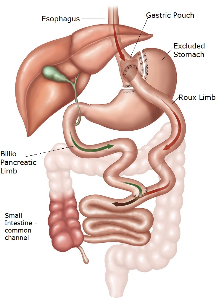 Laparoscopic Gastric Bypass Treatment